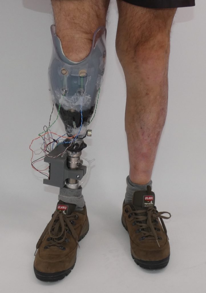 De l’art de rendre une prothèse tibiale connectée et auto-adaptative ...